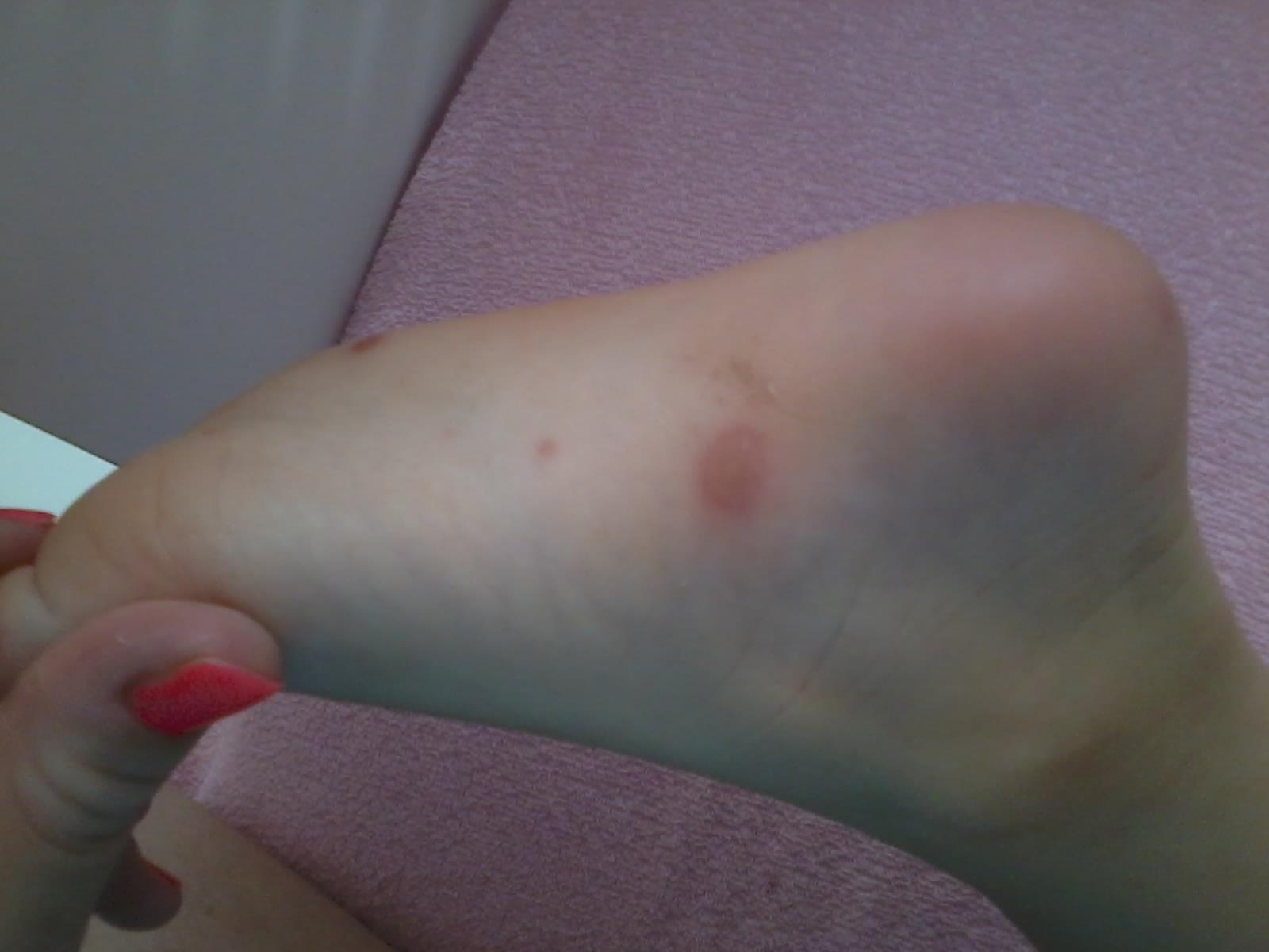 Čo môžu byť pluzgiere na ručičkách a nožičkách? - Modrý koník