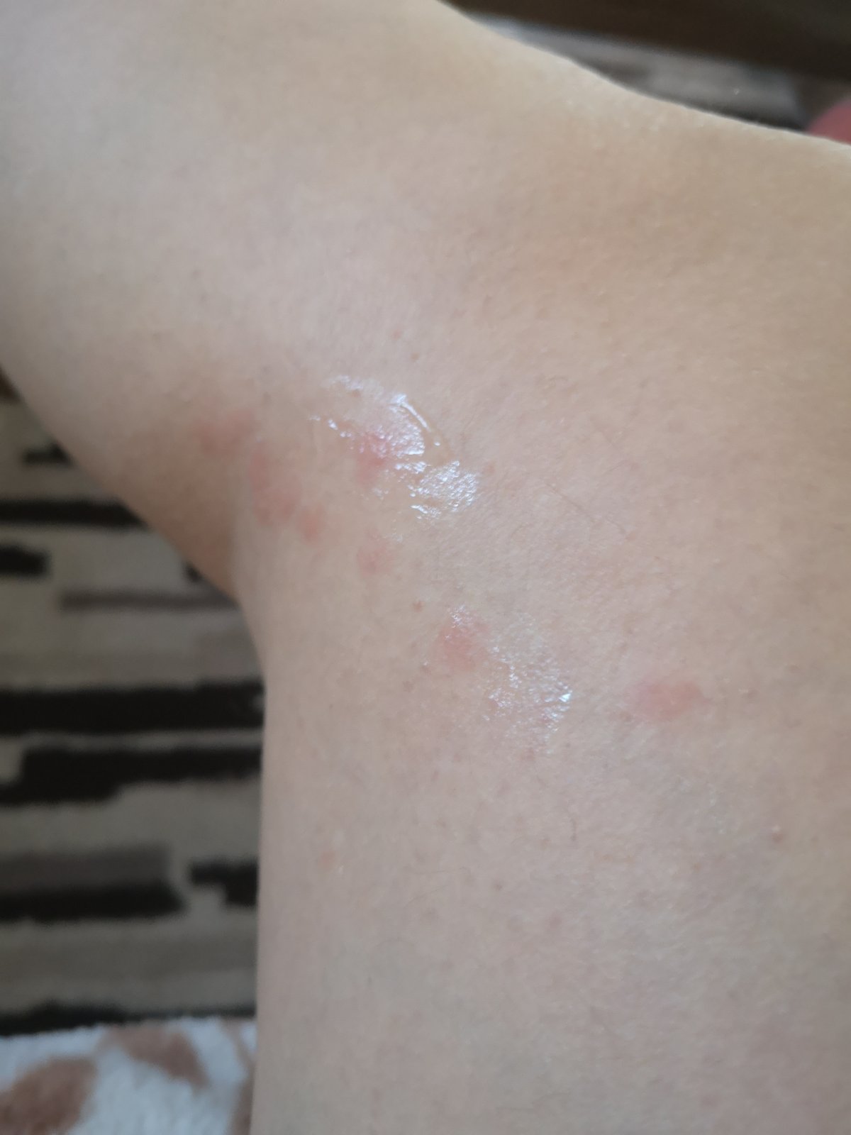 Sú toto štípance od ploštice? - Modrý koník