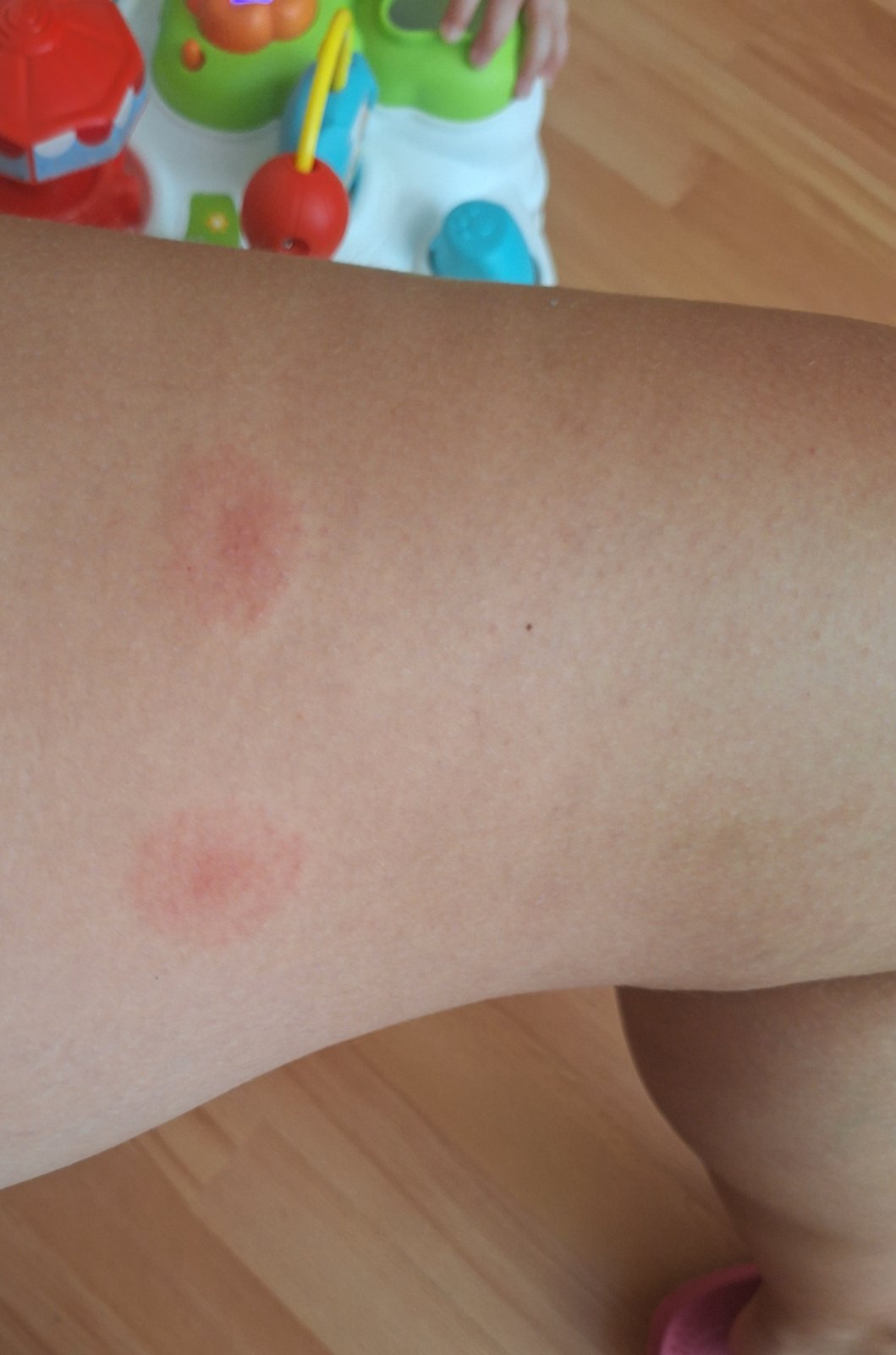 Štípance od komára - Modrý koník