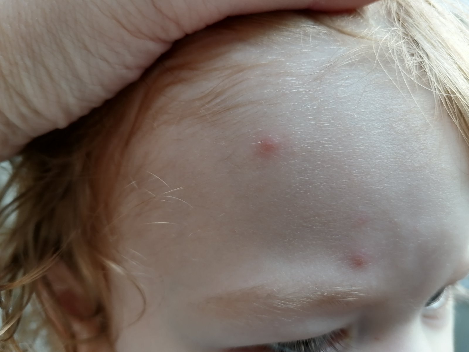 [Zodpovedané] Dostal môj syn ovčie kiahne? - Modrý koník