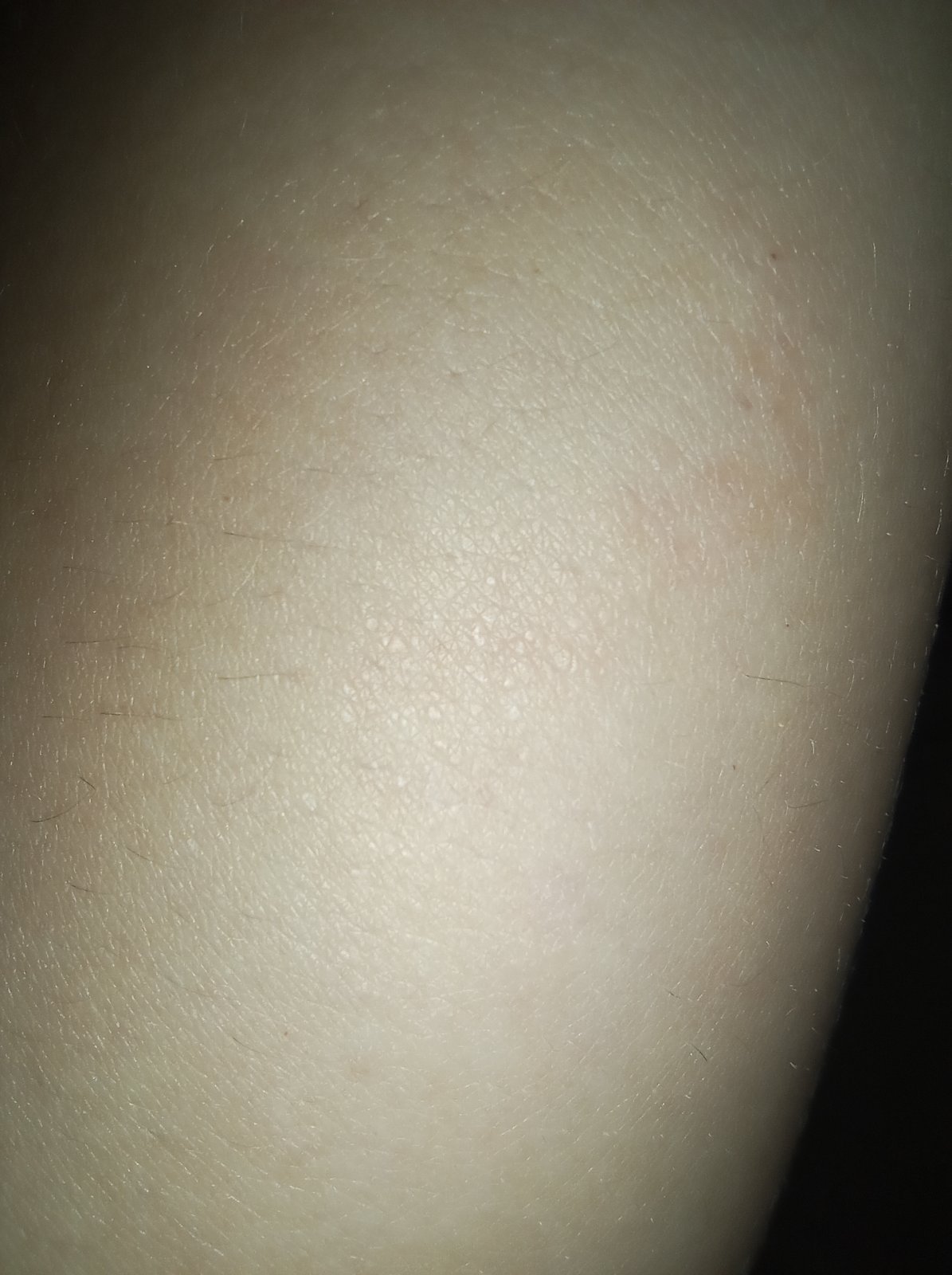 Zvláštne vyrážky na ruke - Modrý koník