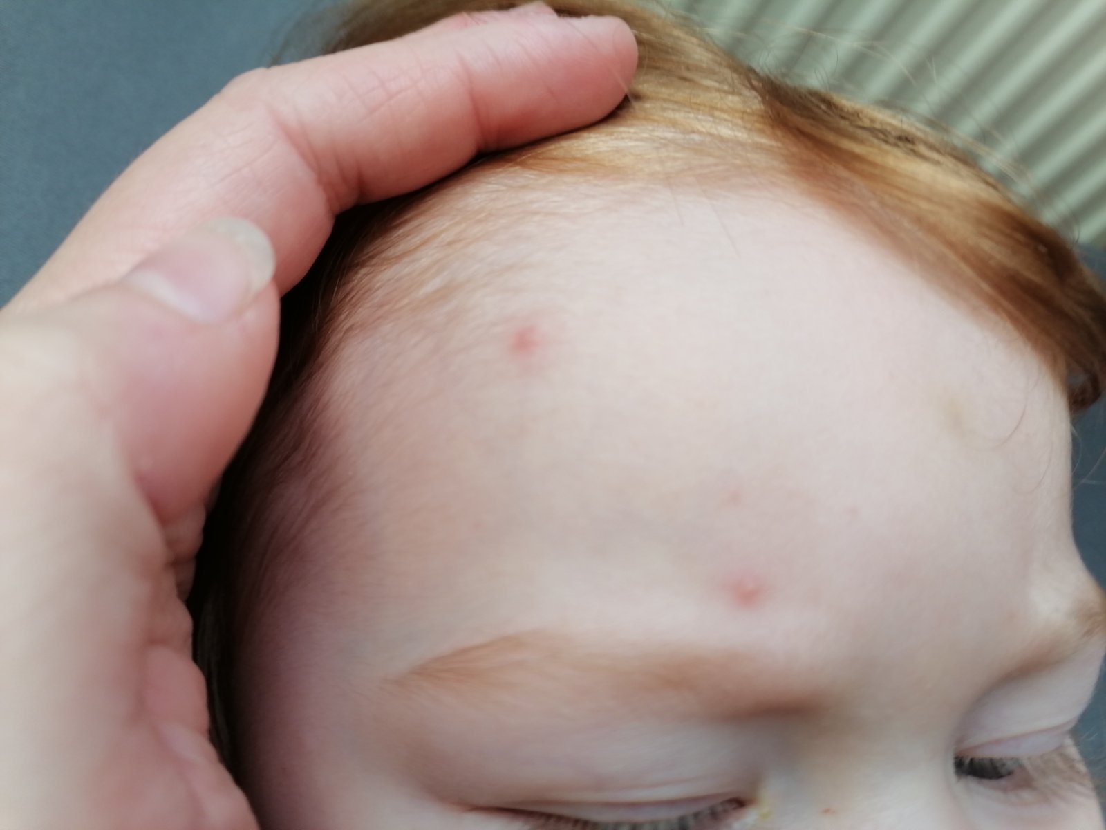 [Zodpovedané] Dostal môj syn ovčie kiahne? - Modrý koník