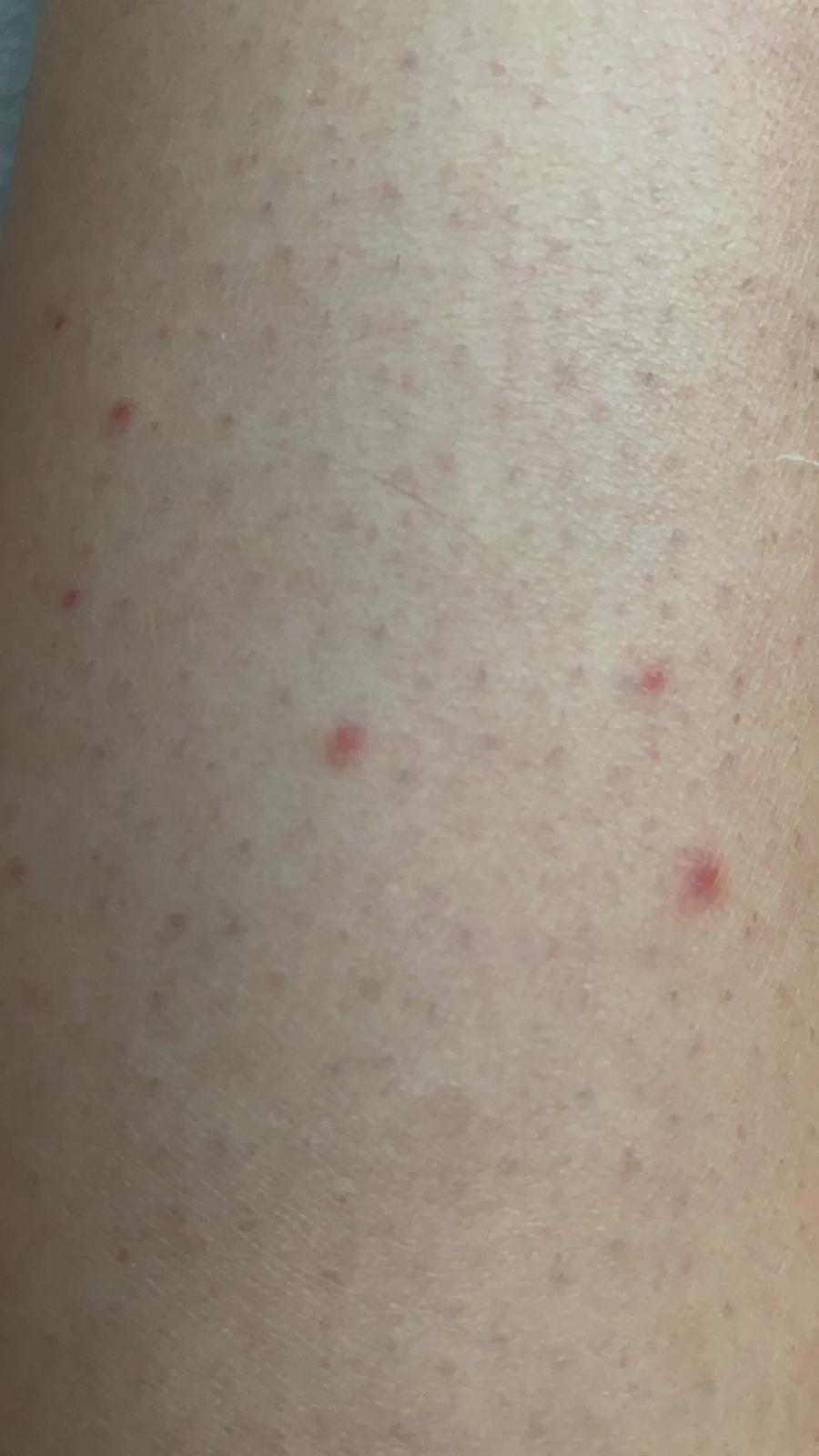 Vyrážky na nohách a rukách - Modrý koník