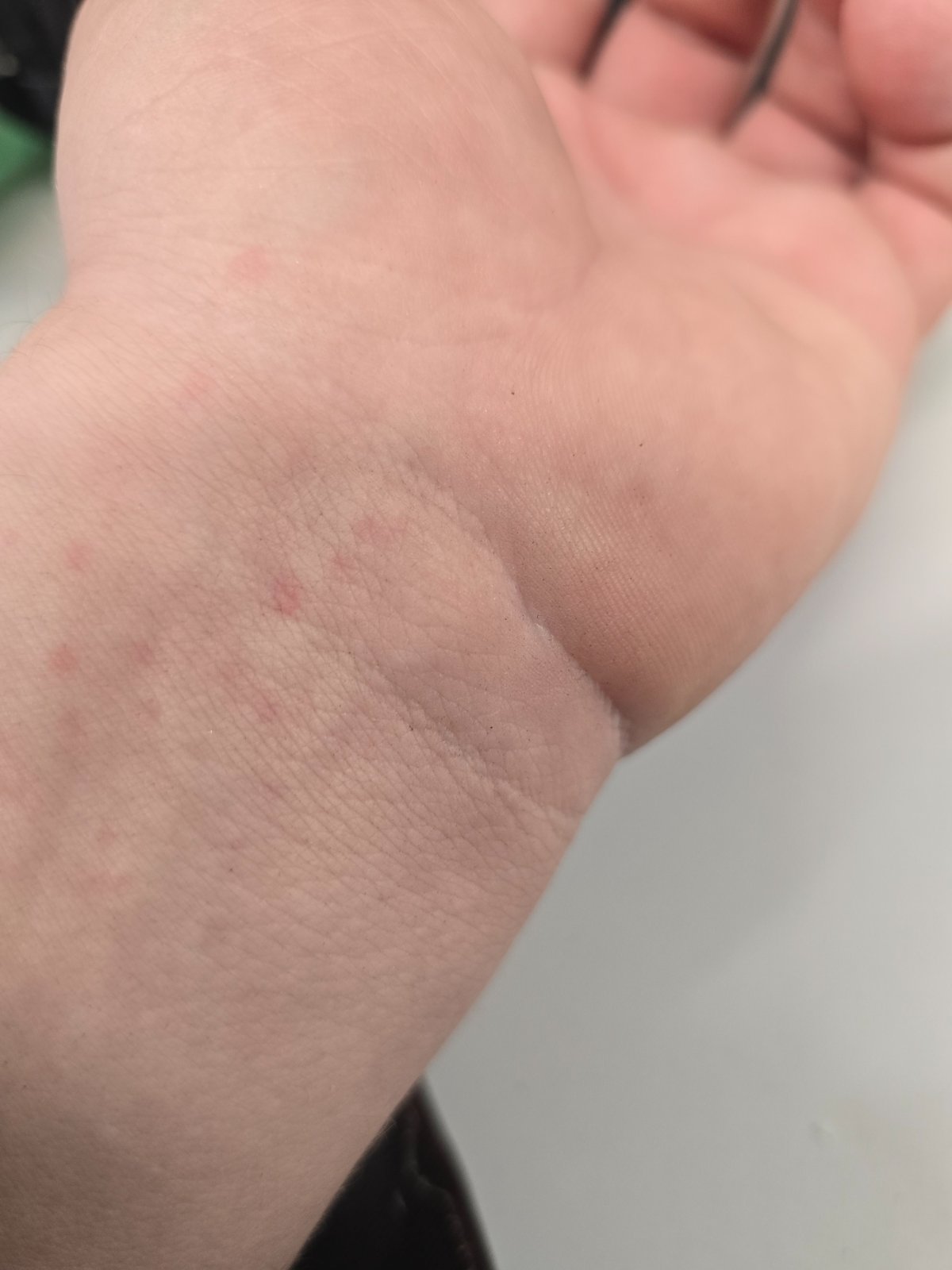 Vyrážky na rukách a tvári - Modrý koník