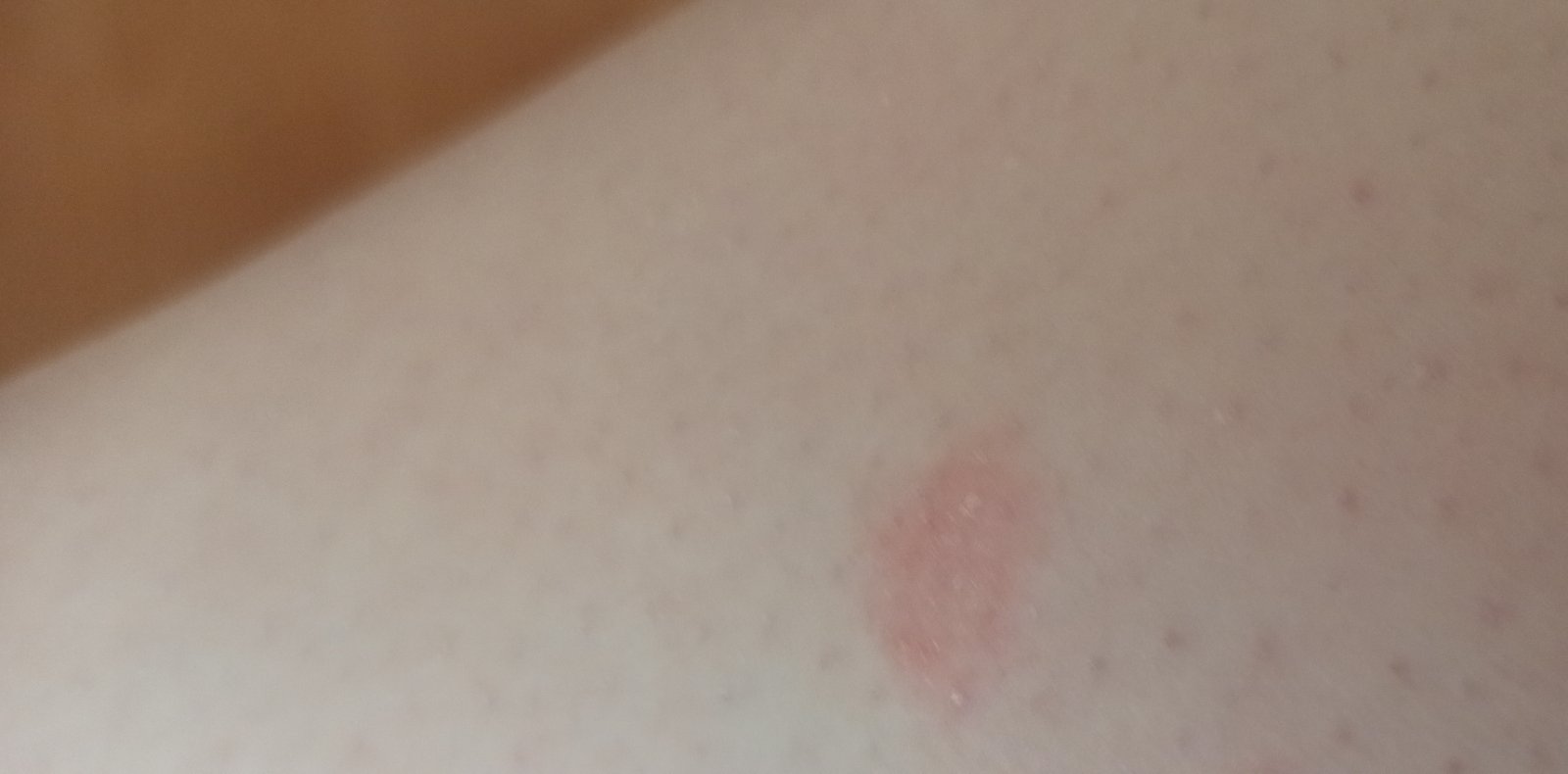 Čo sú to za vyrážky? - Modrý koník