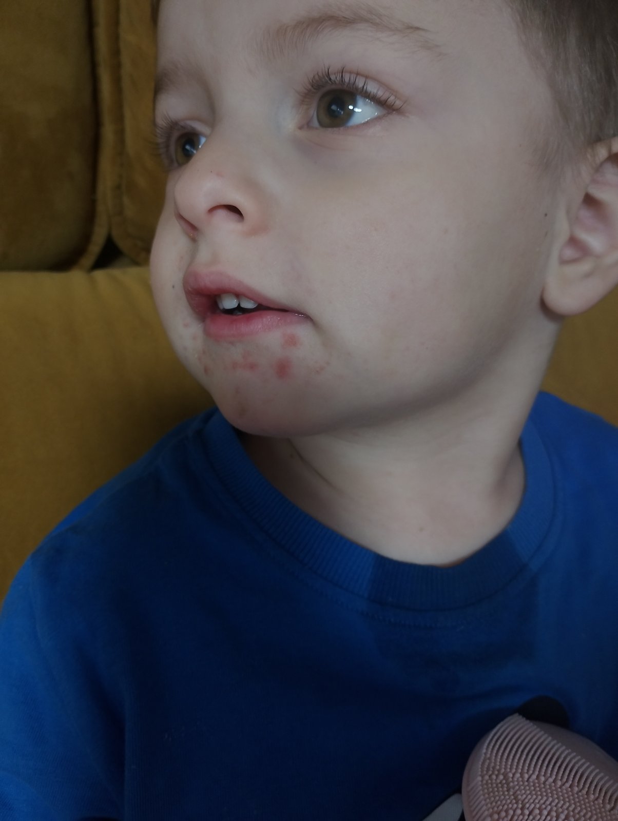 Môžu to byť kiahne? - Modrý koník