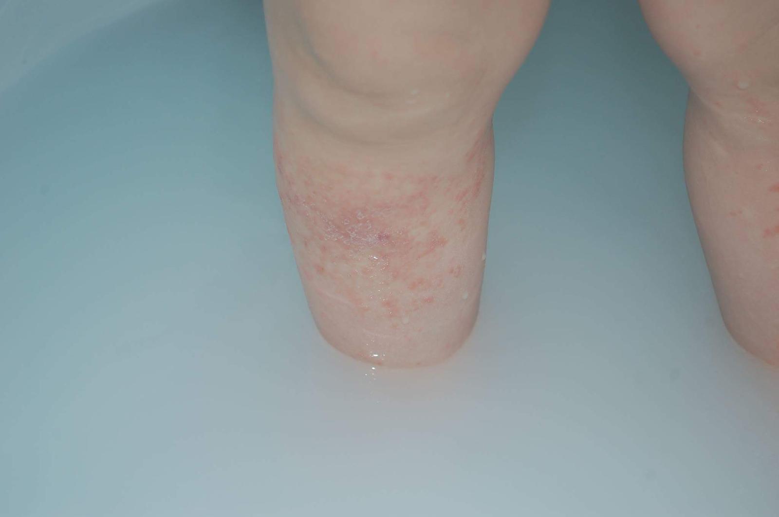 Aké sú toto vyrážky? - str. 2 - Modrý koník