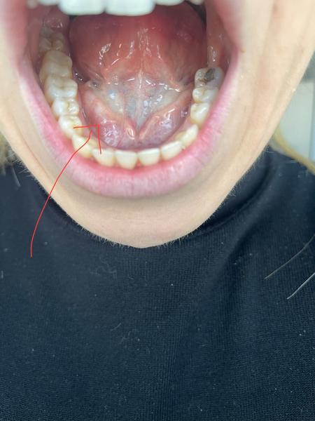 [Zodpovedané] Je zdurená uzlinka pod jazykom v poriadku? - Modrý koník