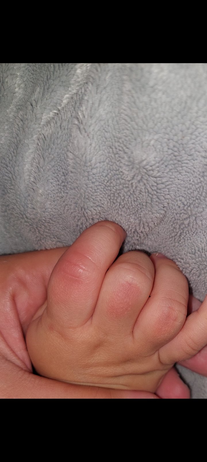 Dieťa má opuchnutý prst - Modrý koník