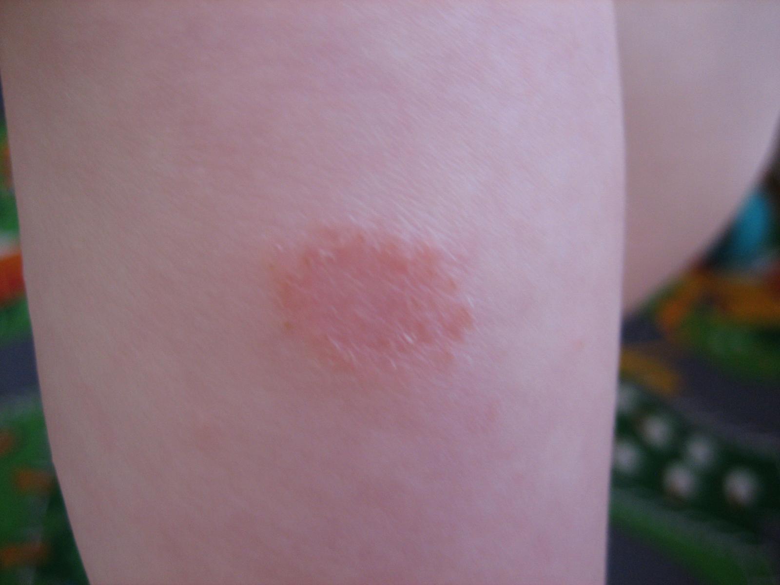 Atopický ekzém u detí. Máte účinné rady, tipy ako ho riešiť? - str. 678 ...