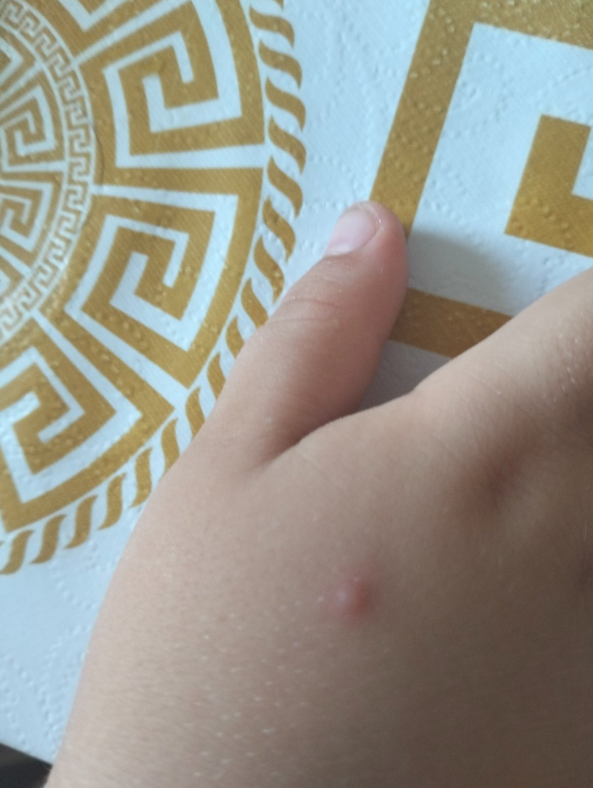 Môžu to byť kiahne? - Modrý koník