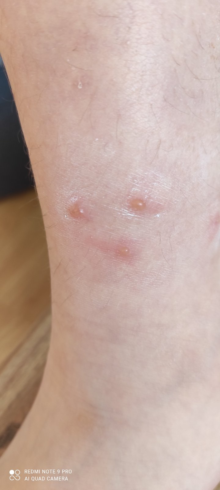 Vodnaté vyrážky - Modrý koník