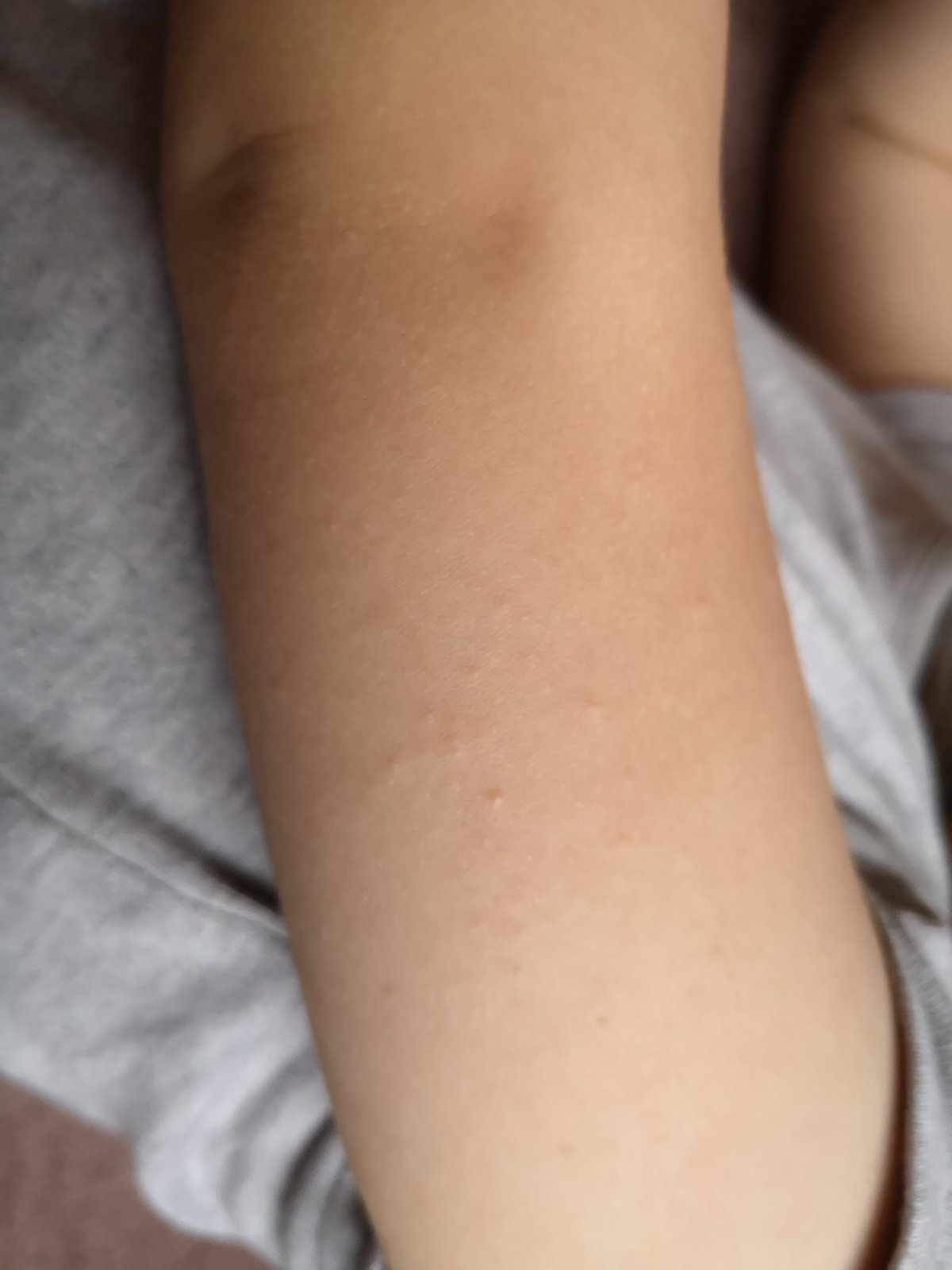 Výsyp na rukách a stenách u dvojročného syna - Modrý koník