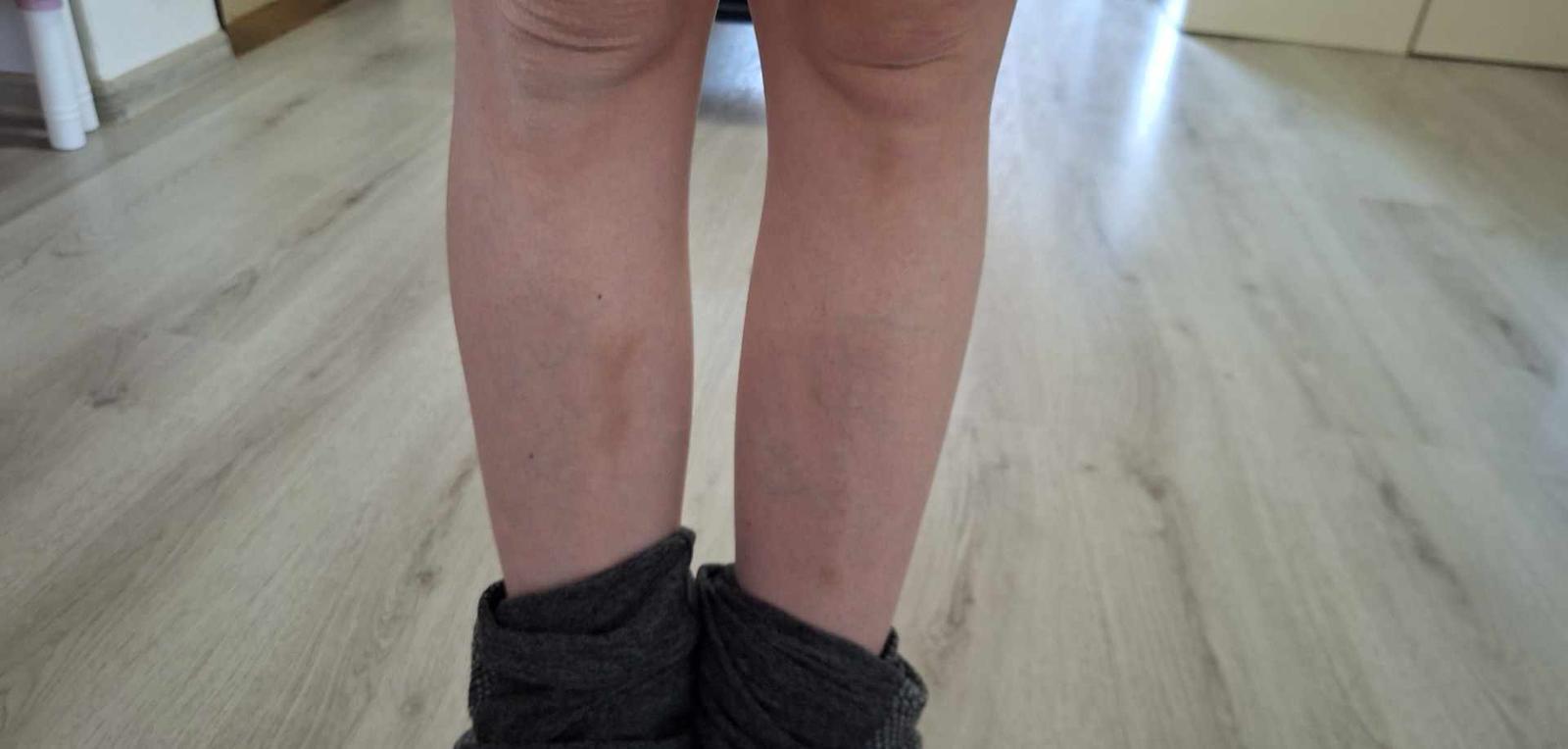 Ide o opuch nôh? - Modrý koník