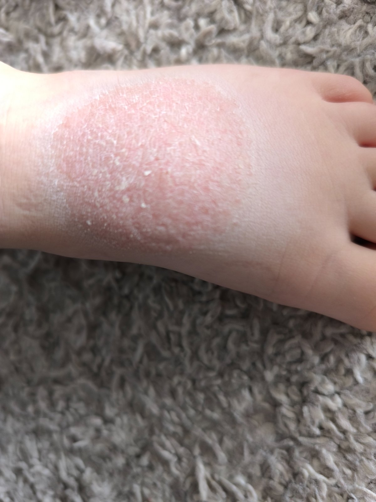 Je to ekzém? - Modrý koník