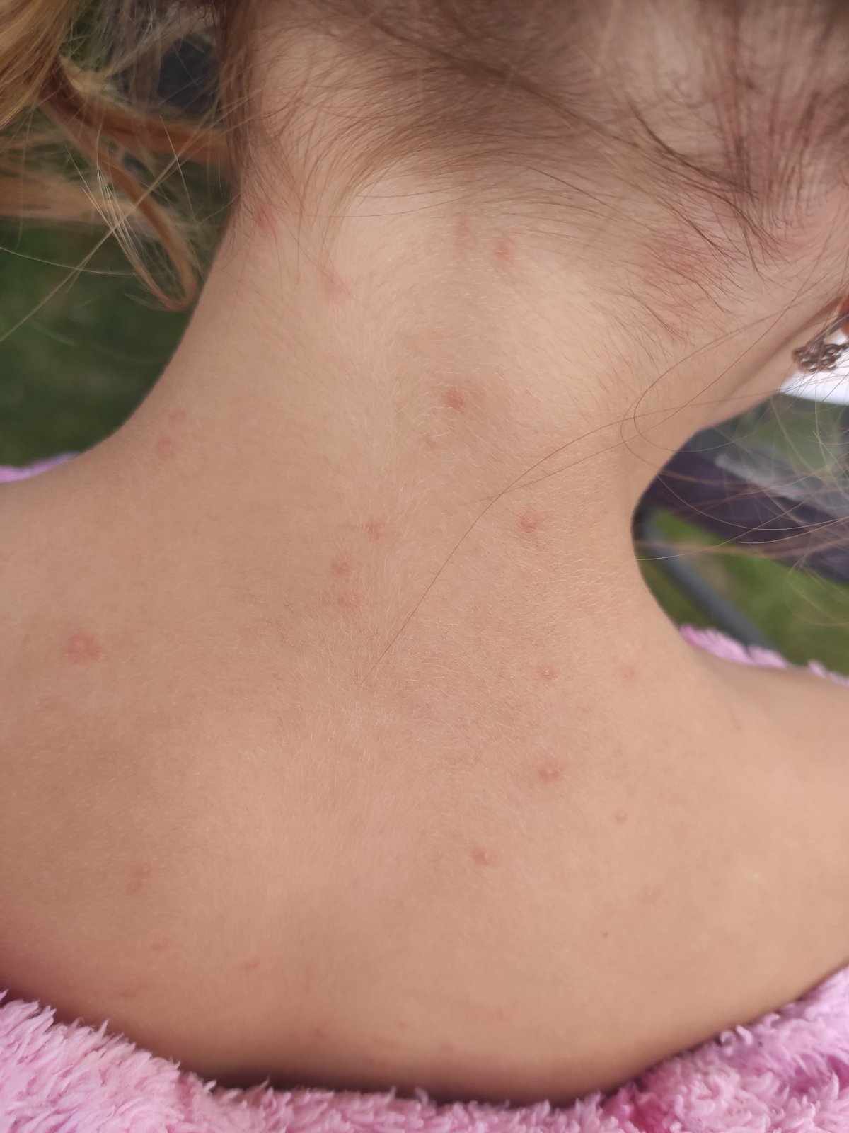 Vyrážky u dcérky - Modrý koník