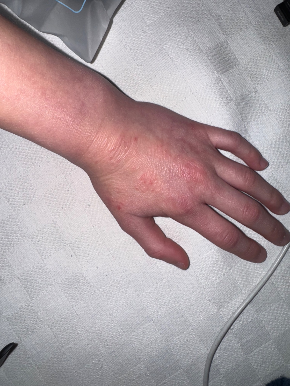 Je toto ekzém? - Modrý koník