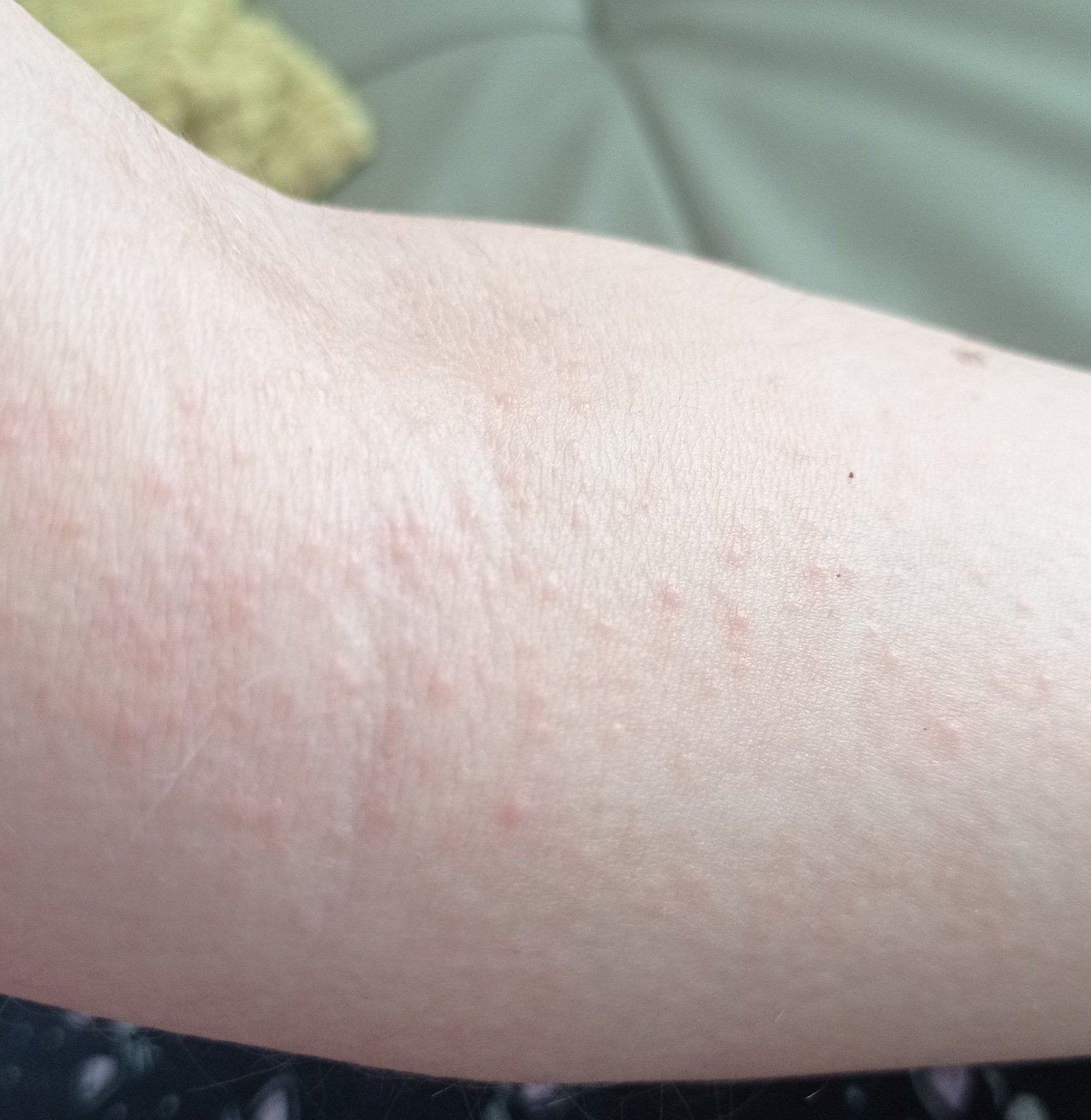 [Zodpovedané] Aké vyrážky mám na rukách? - Modrý koník