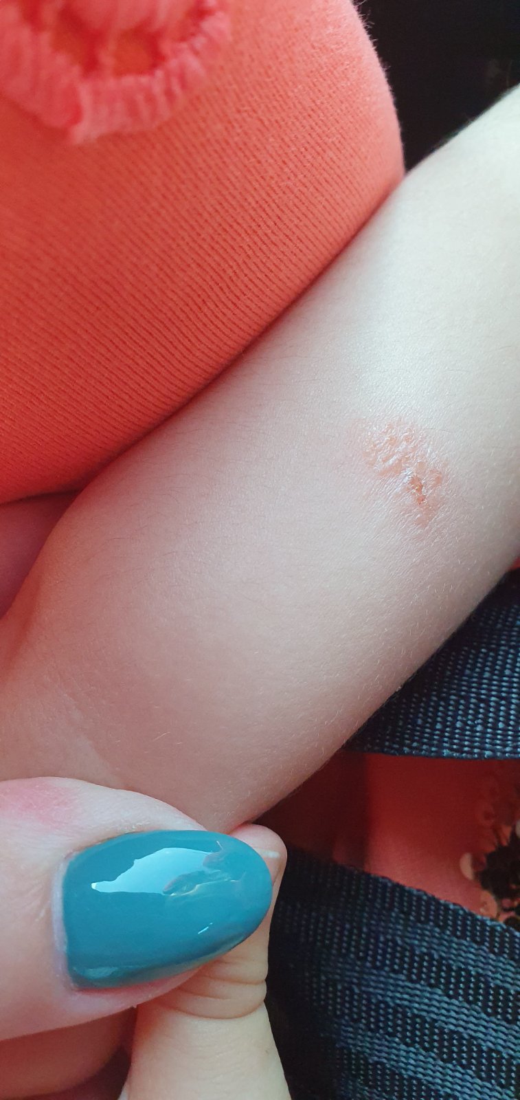 21-mesačná dcéra má vyrážky na rúčke - Modrý koník