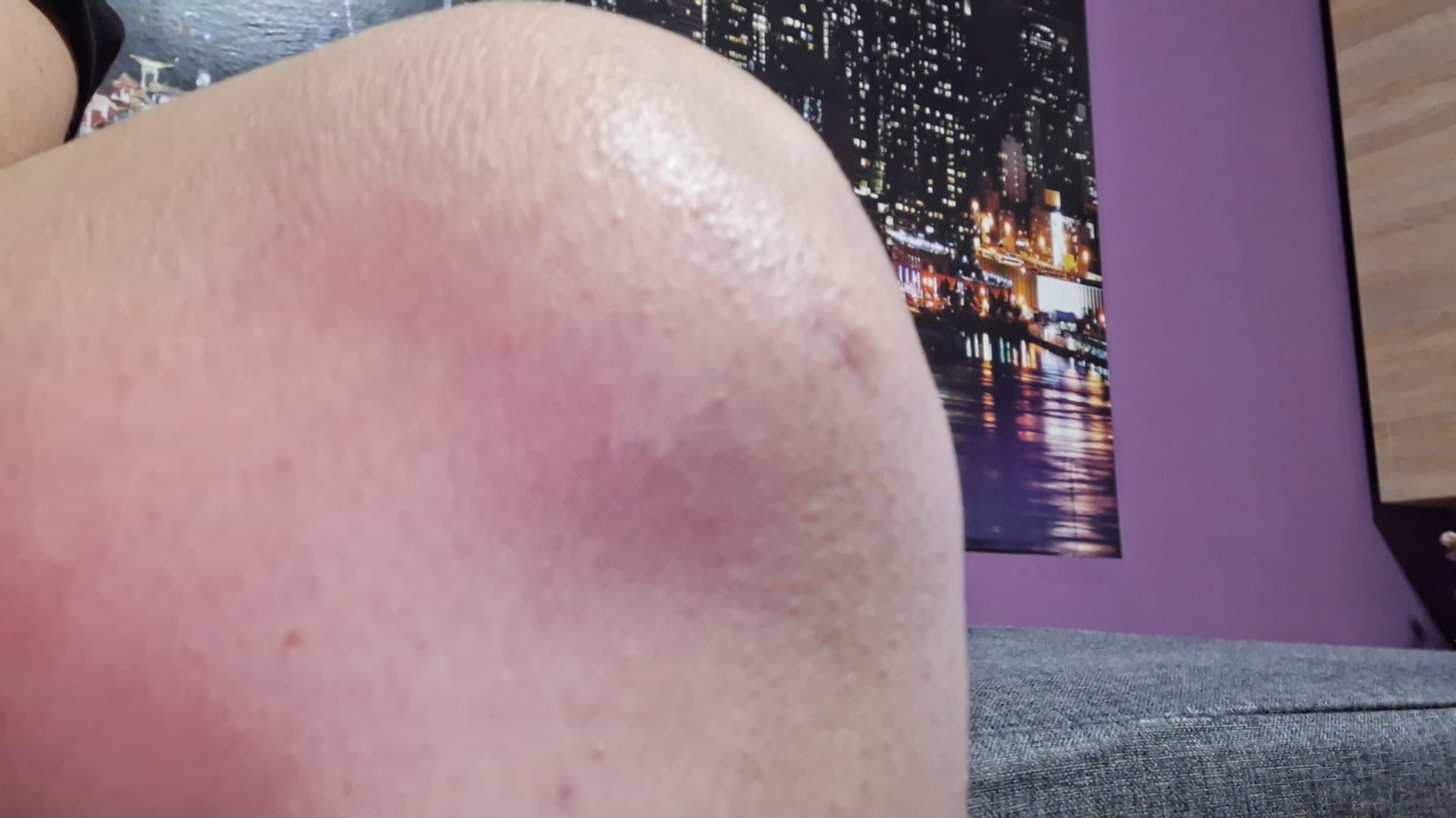 Artroskopia kolena - opuch sedem týždňov po operácii - Modrý koník