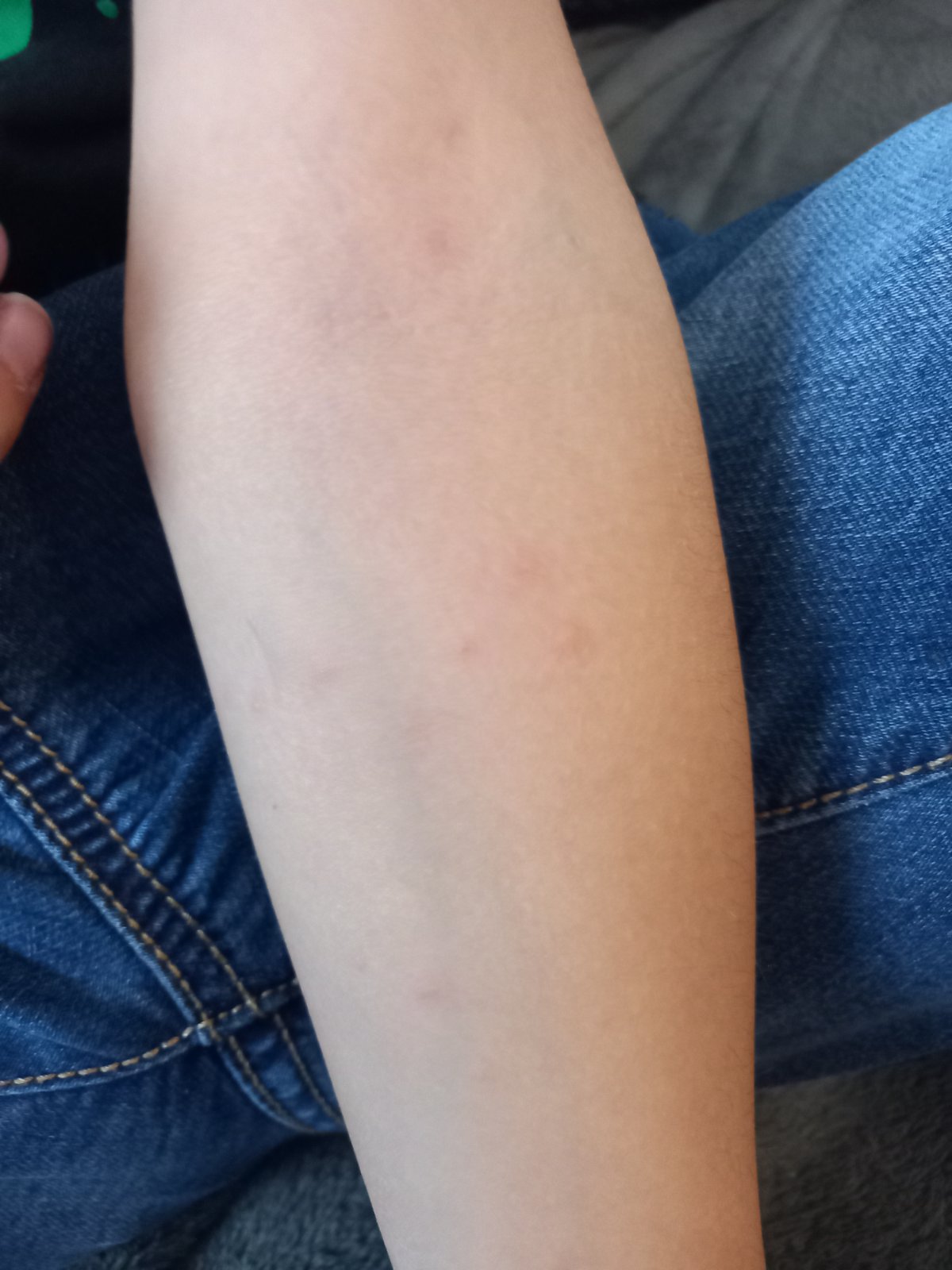 Sú to štípance od blchy alebo ploštice? - Modrý koník