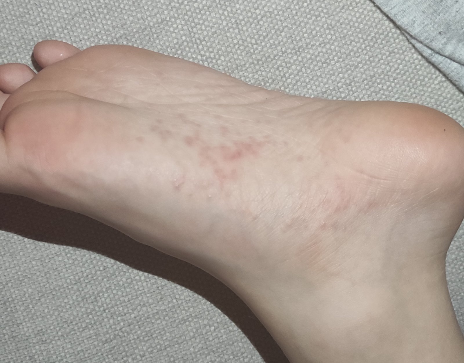 Vyrážky na chodidlách - Modrý koník