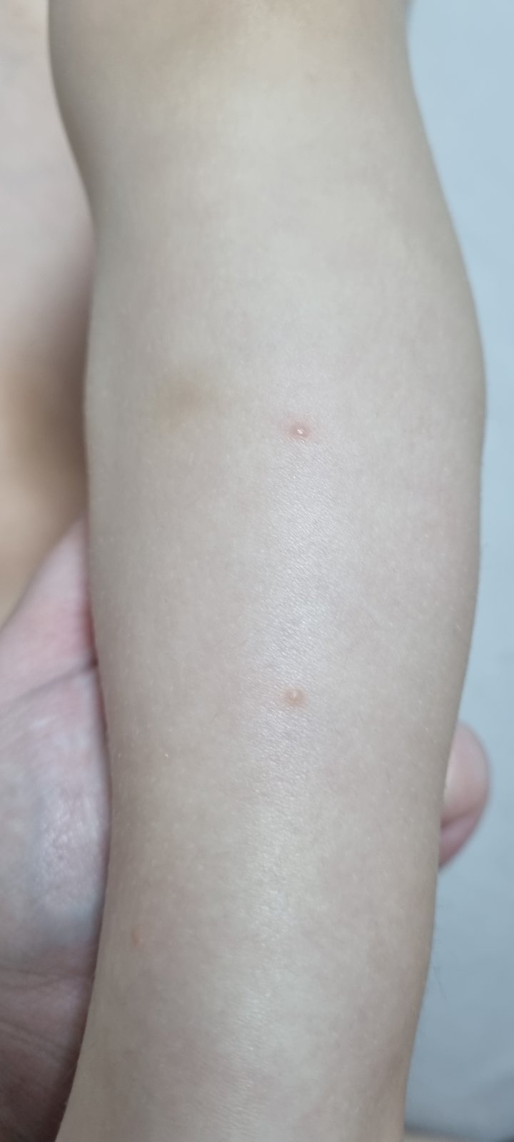 [Zodpovedané] Aké vyrážky sa vytvorili môjmu 3-ročnému synovi? - Modrý ...