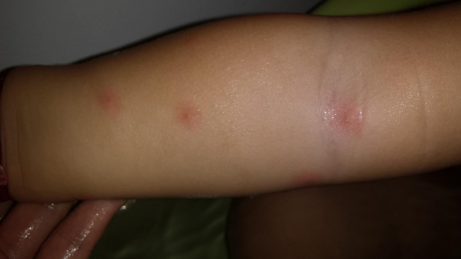 Z čoho sú tieto vyrážky na ručičke? - Modrý koník