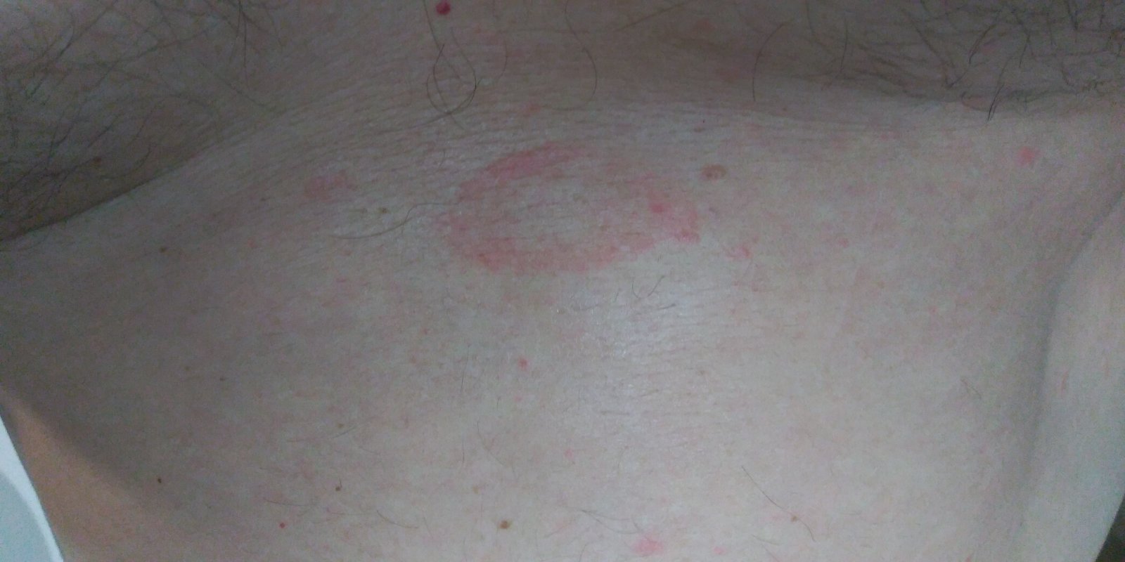 Čo sú to za vyrážky? - Modrý koník