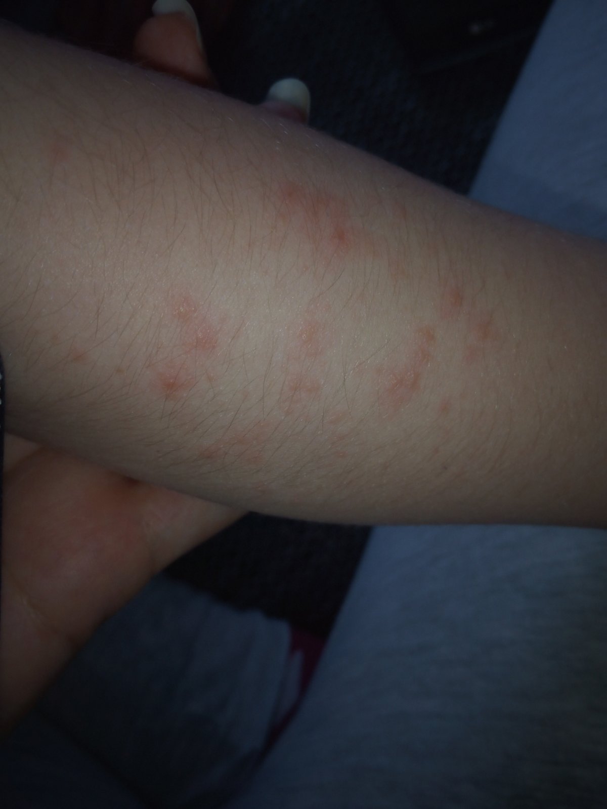 Vyrážky na rukách 3,5-ročnej dcérky - Modrý koník