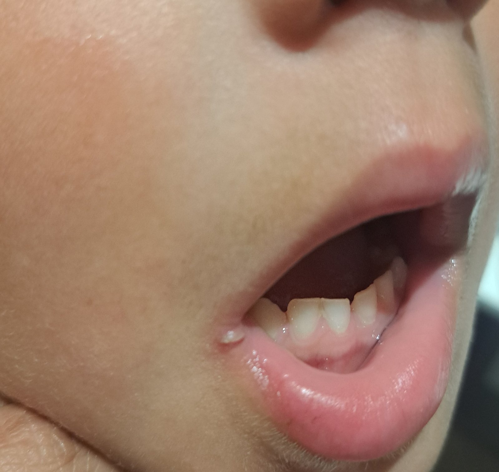 Opuch na perách u dieťaťa - Modrý koník