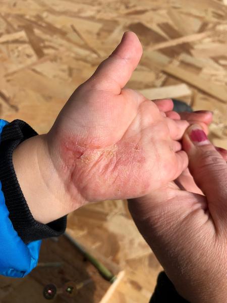 Ekzém u syna na ruke - Modrý koník