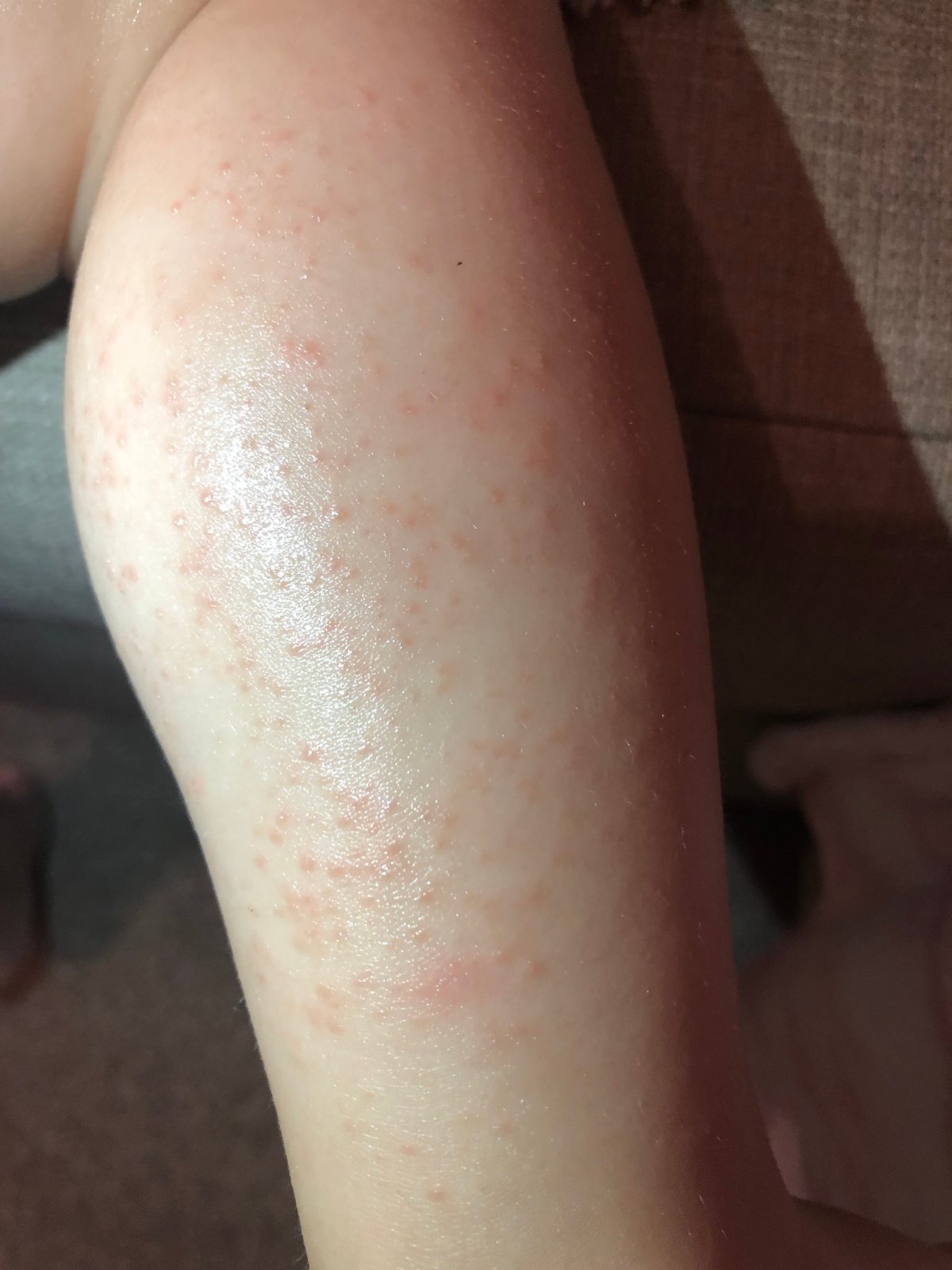 Drobné vyrážky na lýtkach, stehnách a rukách 20-mesačného bábätka ...