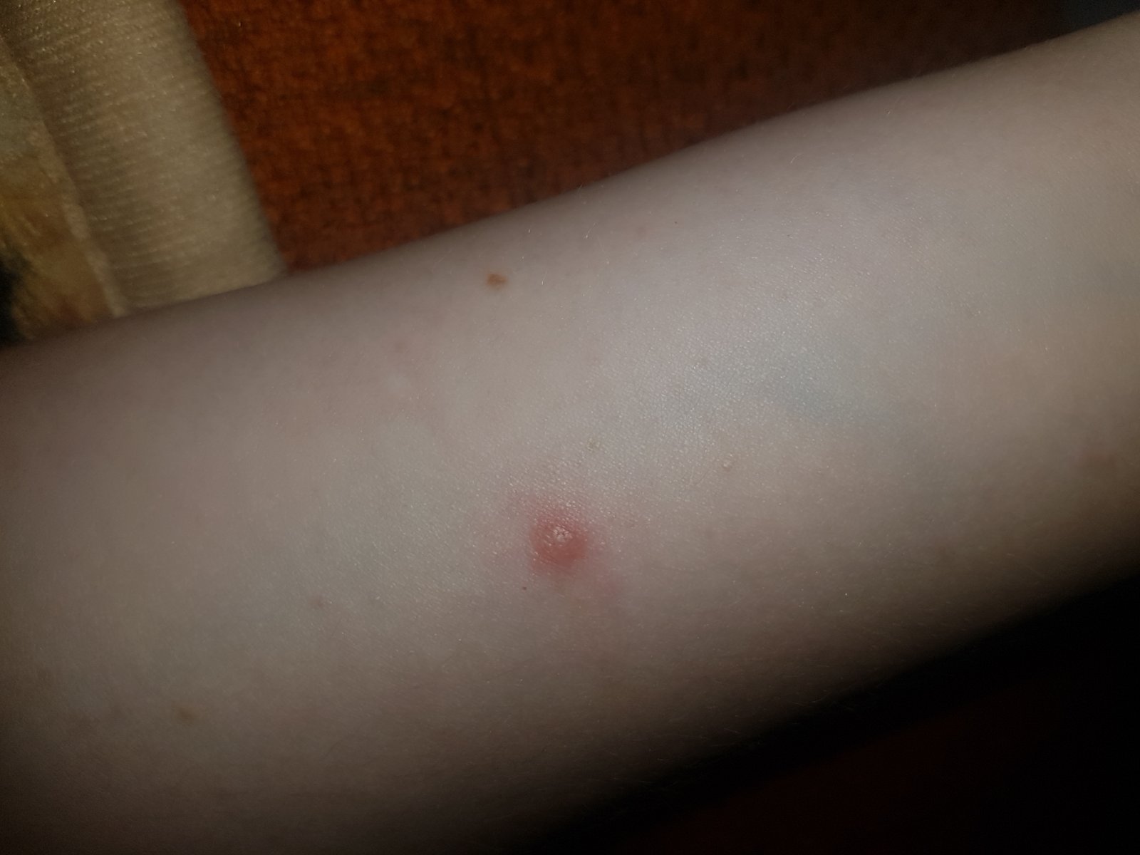 Vyrážka na ruke - Modrý koník