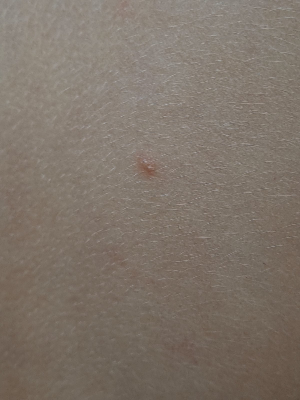 Môžu byť toto ovčie kiahne? - Modrý koník