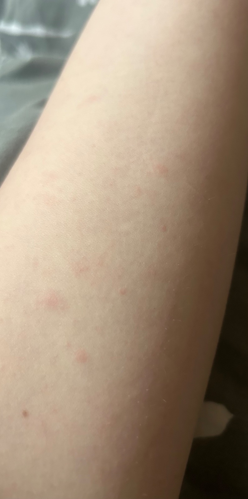 Vyrážky na predlaktí - Modrý koník