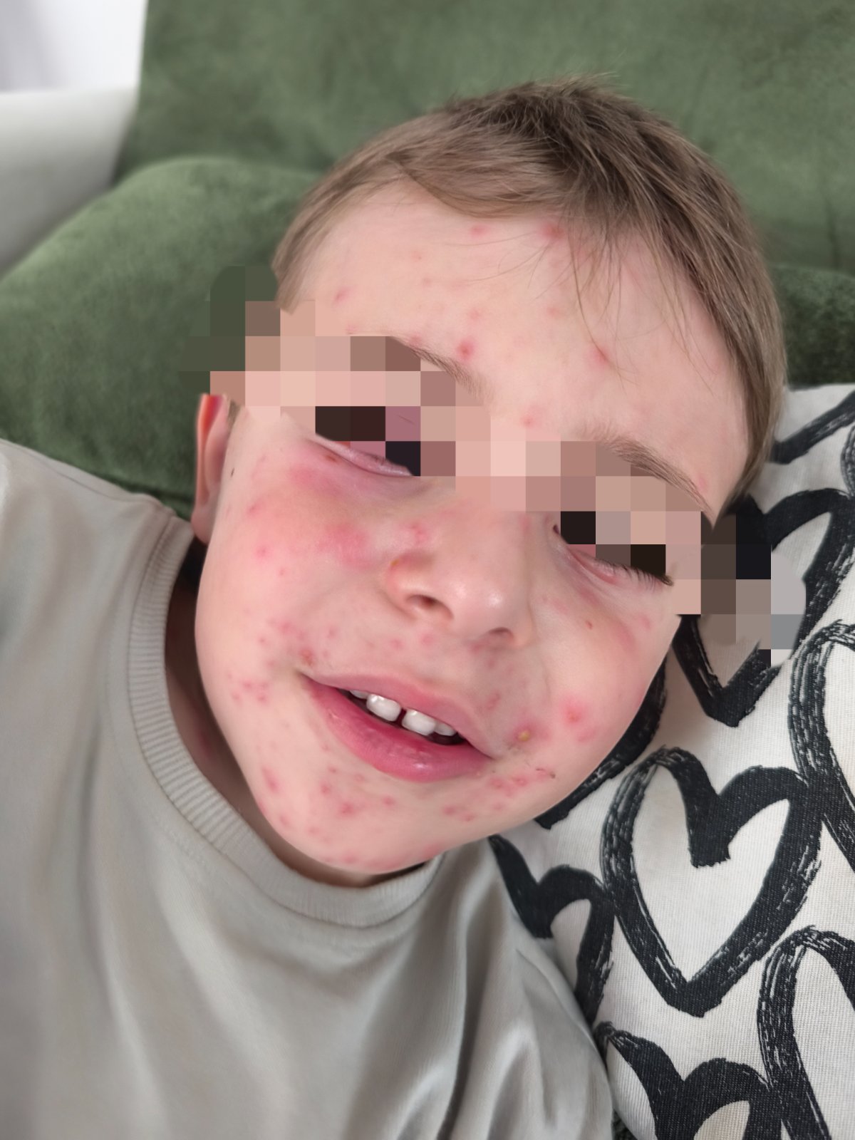 Samoliečba kiahní: -Fenistil a hypermangán - Modrý koník