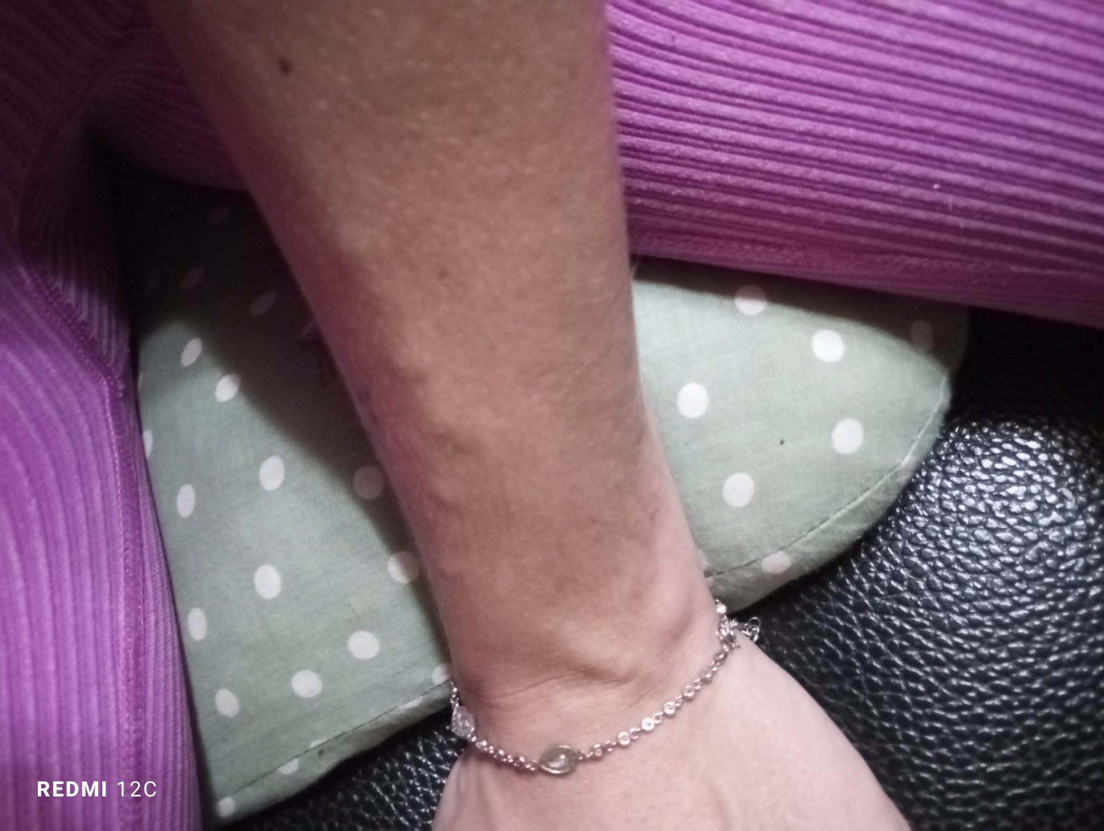 Hrčky na žile - Modrý koník