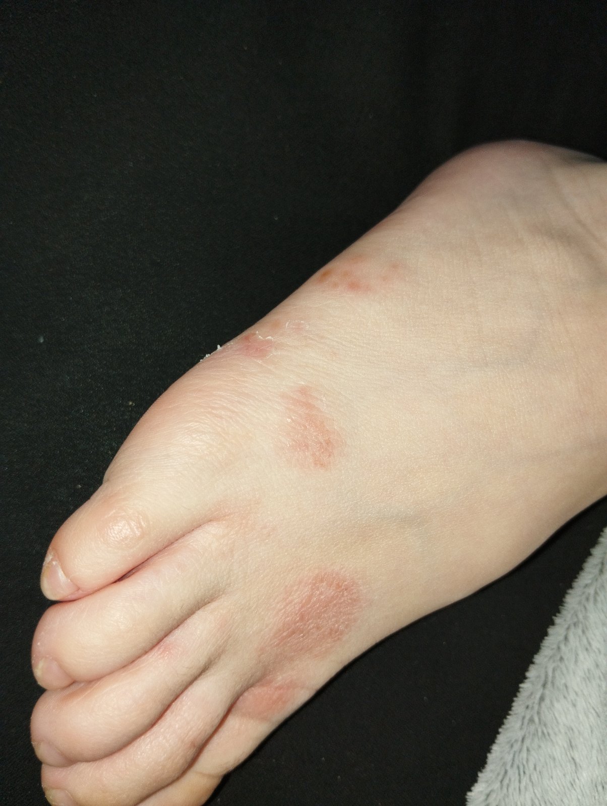 Červené fľaky na nohe - Modrý koník