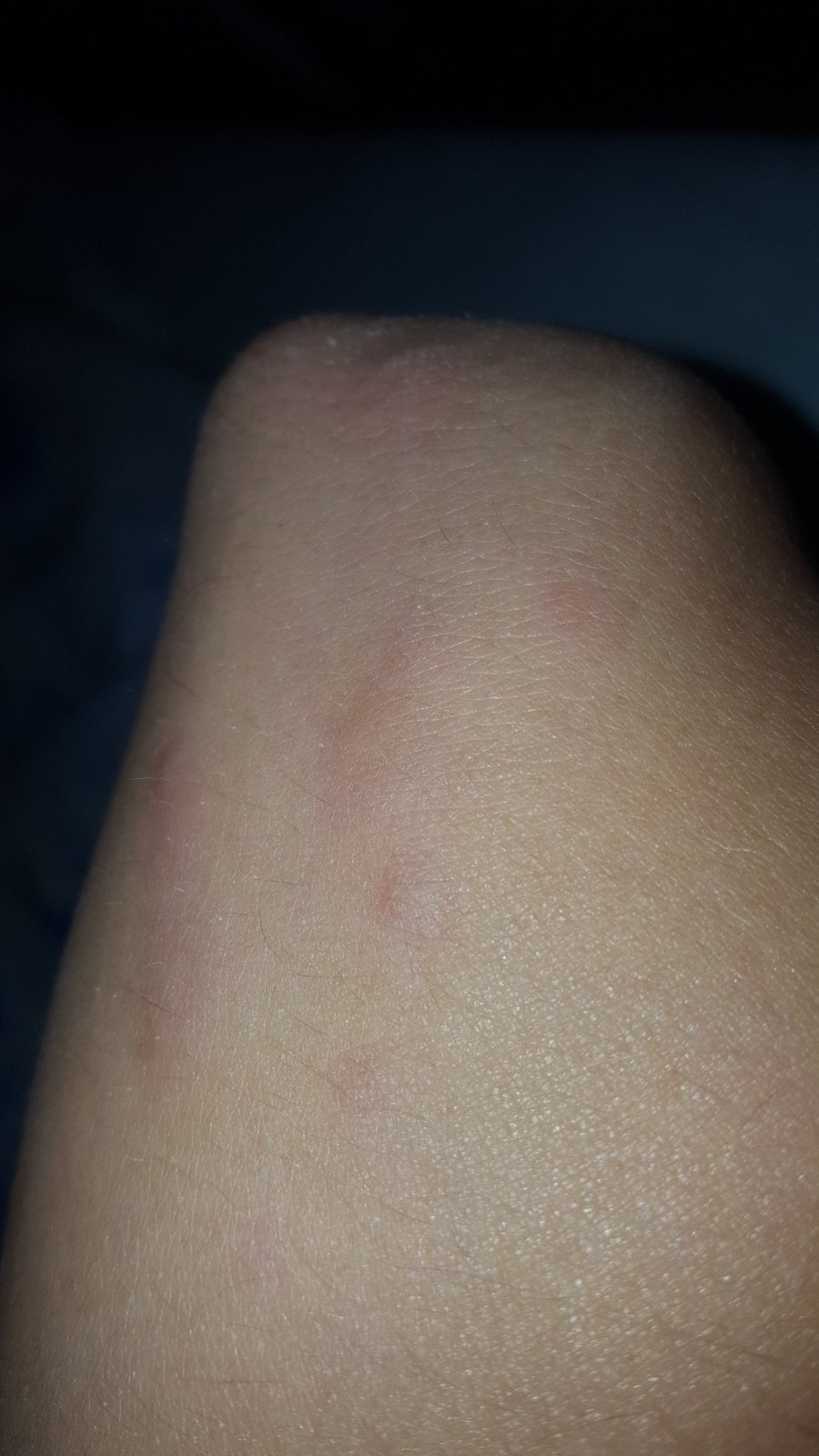 Miznúce svrbivé štípance? - Modrý koník