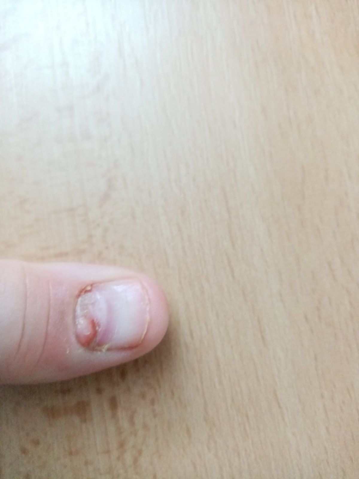 Problém s palcom na ruke - Modrý koník