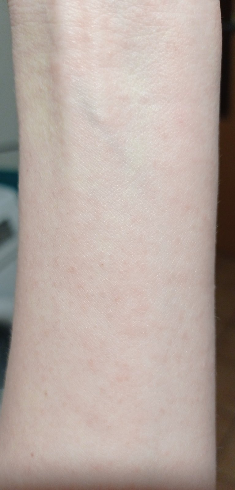 [Zodpovedané] Aké vyrážky mám na rukách? - Modrý koník