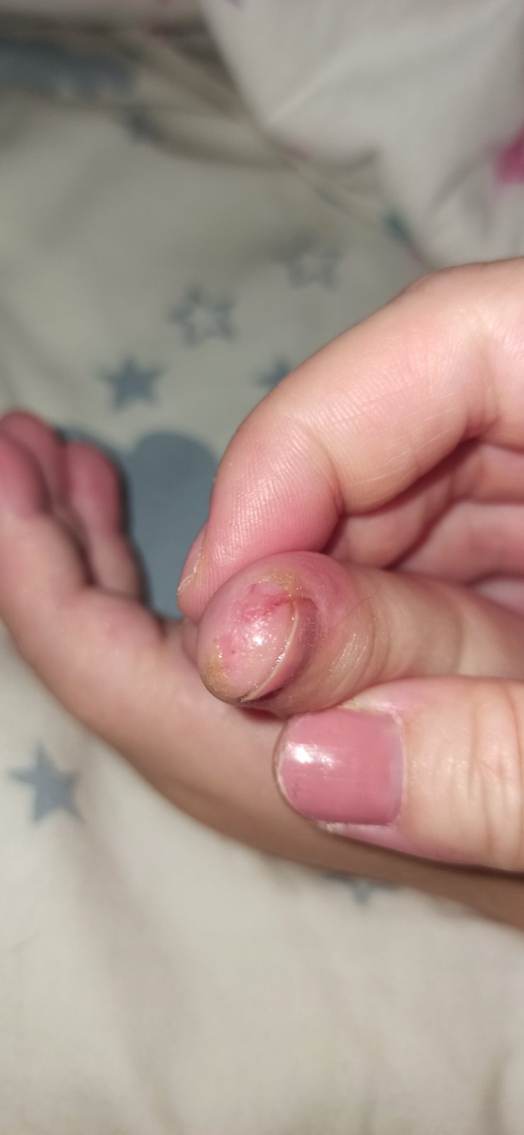 Čo to má 3,5-ročná dcérka na ruke? - Modrý koník