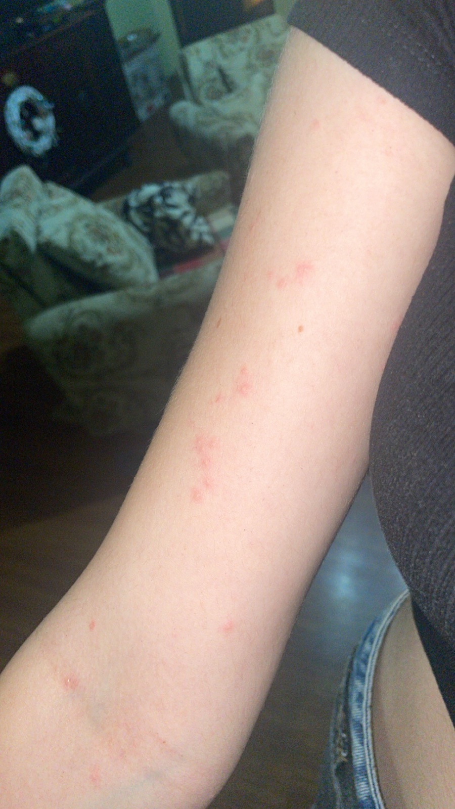 Vyrážky na rukách: Ako zistiť príčinu? - Modrý koník