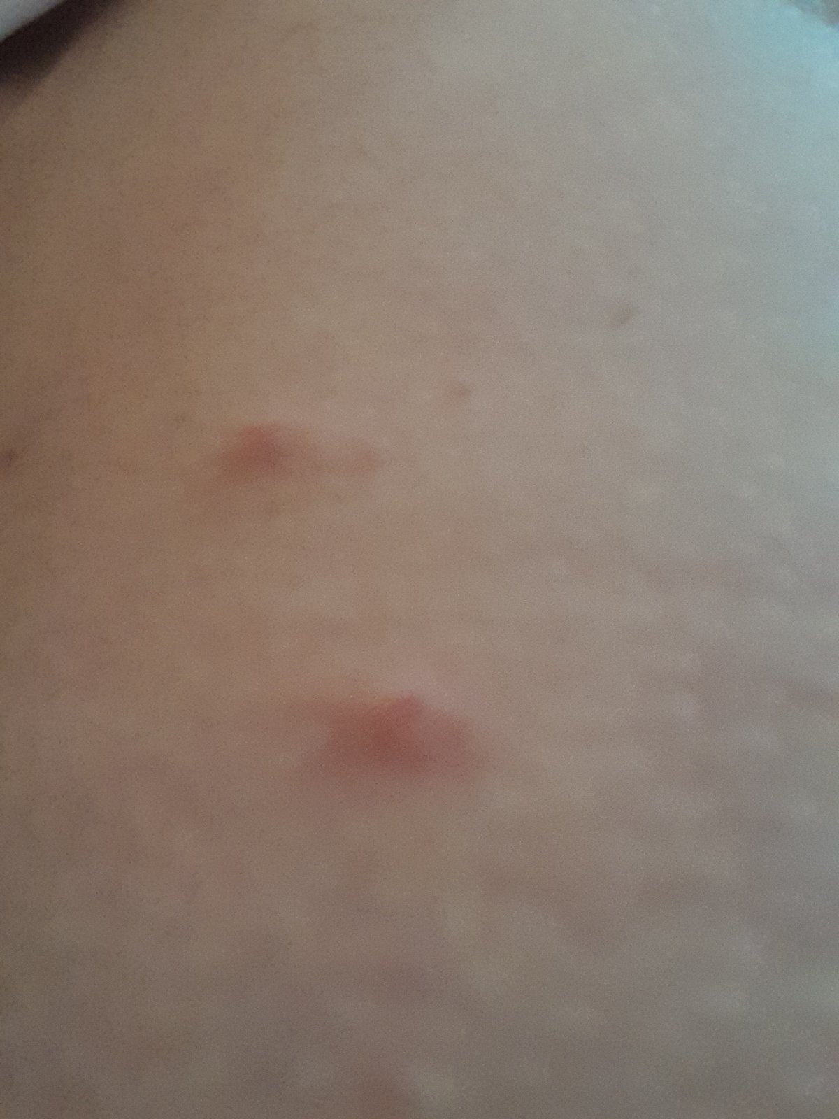 Ja a aj manžel máme štípance, ktoré svrbia - Modrý koník