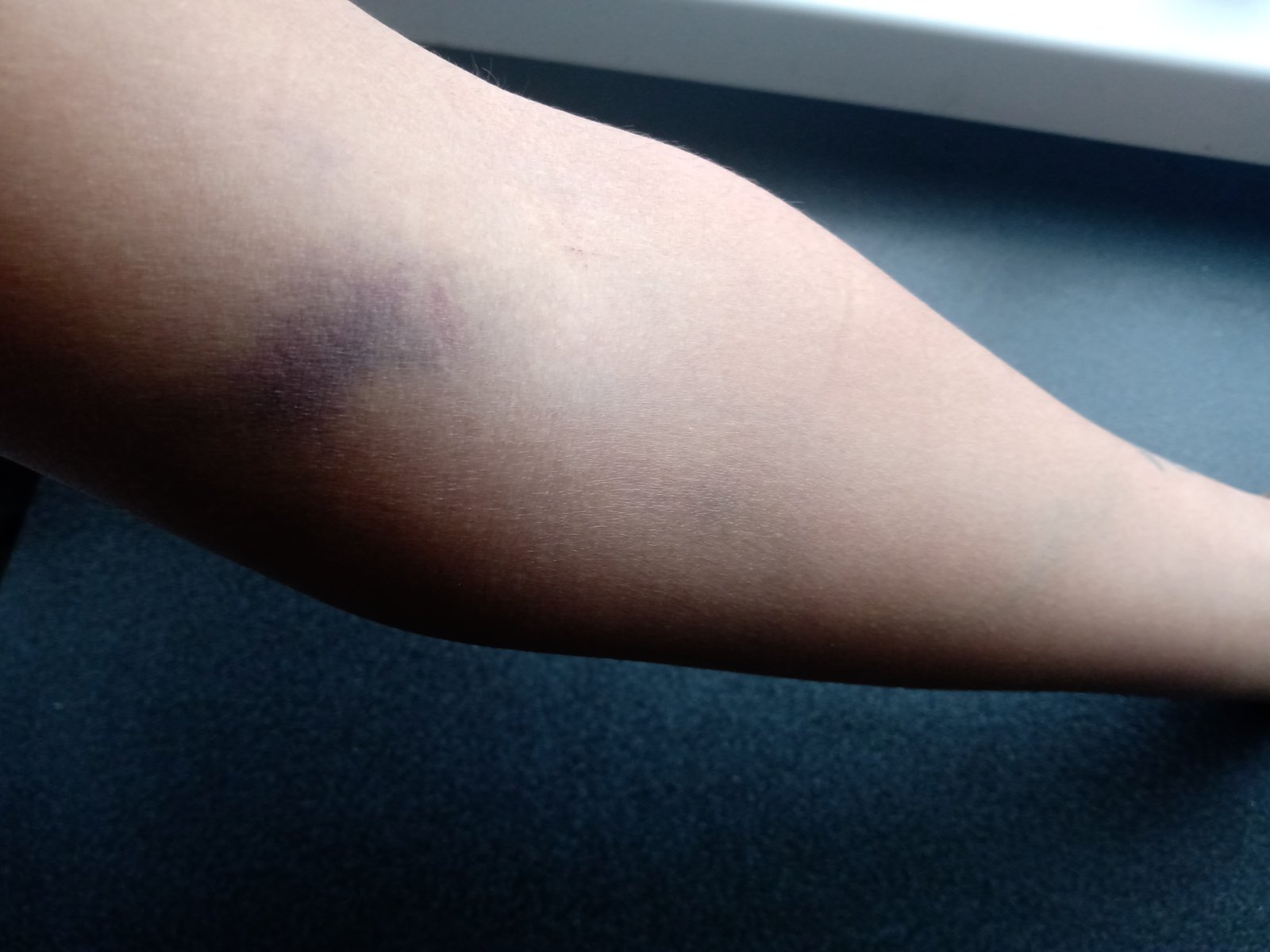 Opuch po odbere krvi - Modrý koník