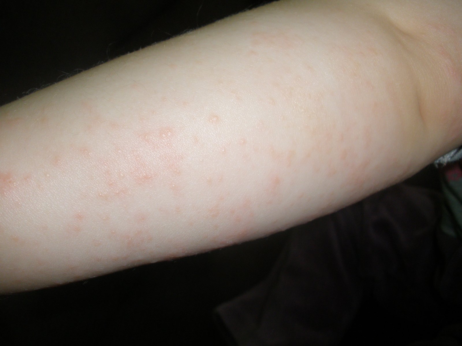 Čo znamenajú tieto vyrážky? - Modrý koník