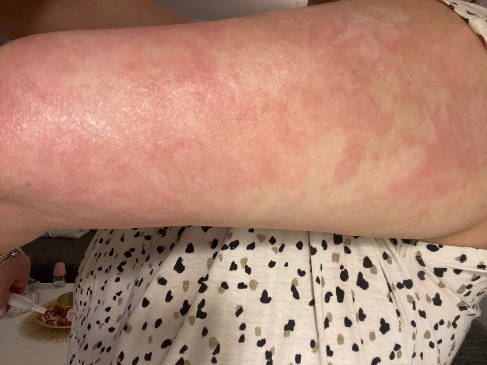 Zhoršený atopický ekzém po tehotenstve - Modrý koník