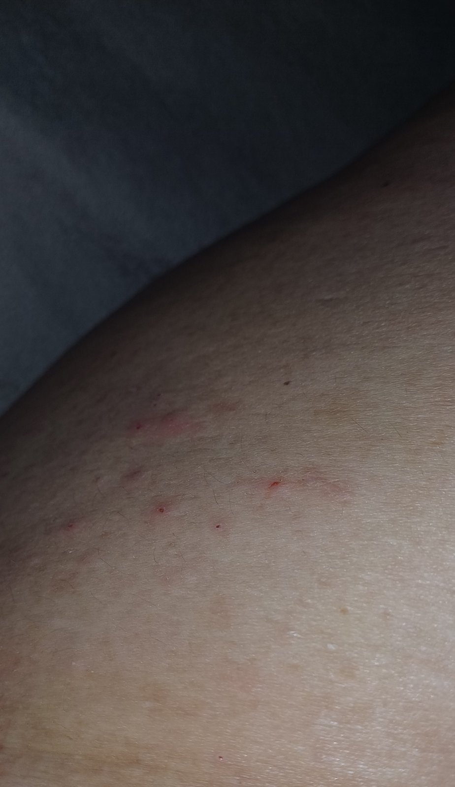 Červené bodky po tele - Modrý koník