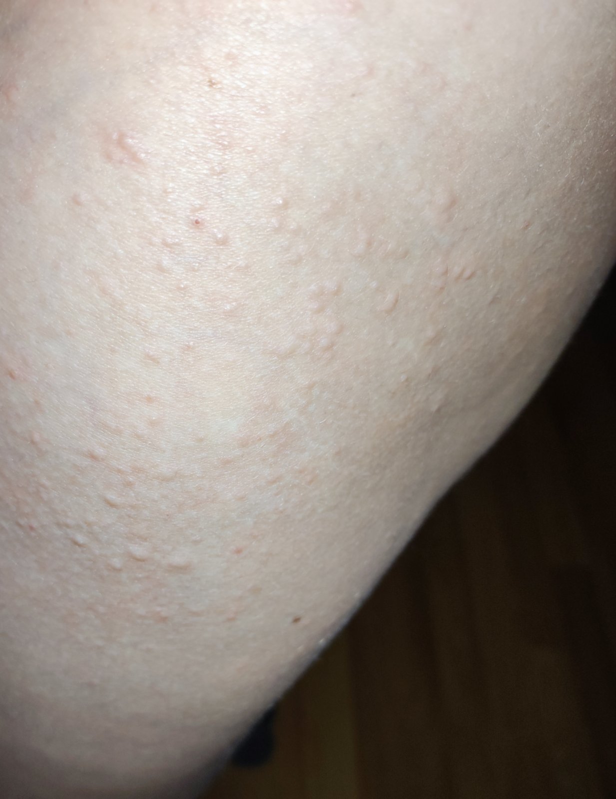 Vyrážky a svrbenie v 13. týždni tehotenstva: Ako si pomôcť? - Modrý koník